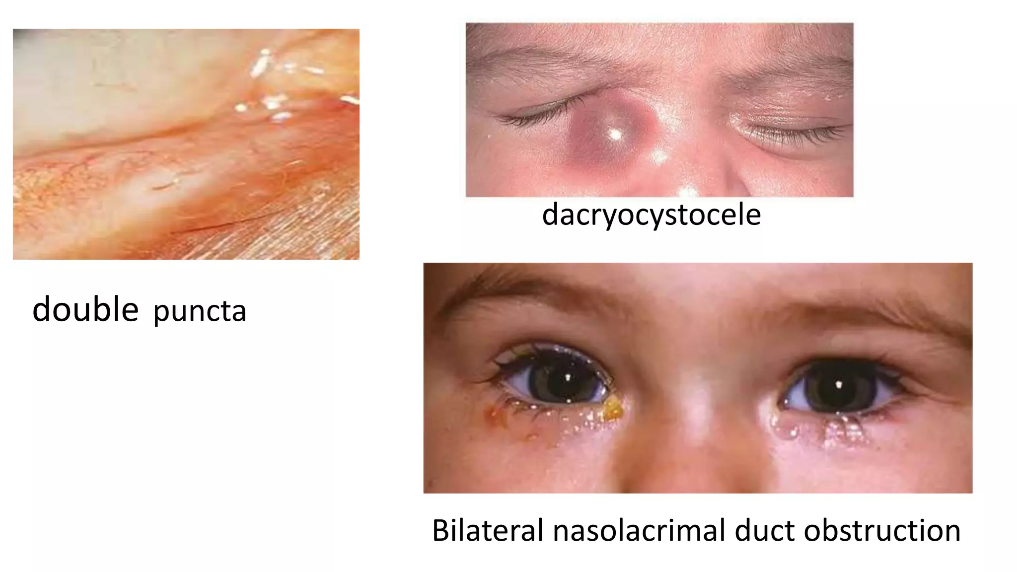 LACRIMAL APPARATUS- ANATOMY & PHYSIOLOGY | PPTX