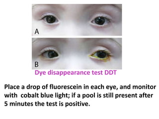 Lacrimal disorders | PPTX