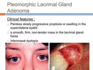 Pleomorphic Adenoma Lacrimal Gland