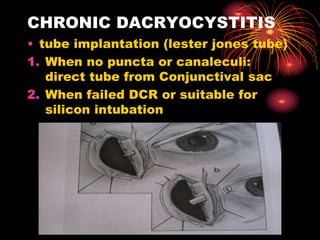 Lacrimal lecture by dr.abdul basir safi | PPT