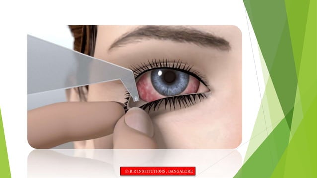 Lacrisert.pptx | Eye and Vision Conditions | Diseases and Conditions