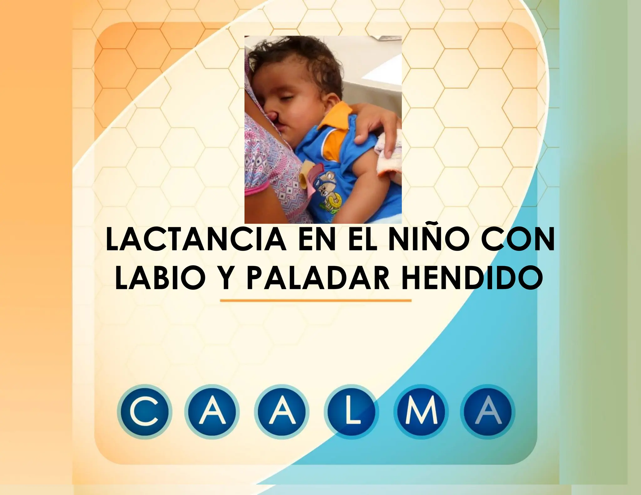 LACTANCIA EN EL NIÑO CON LABIO PALADAR HENDIDO.pdf | Ear, Nose and ...