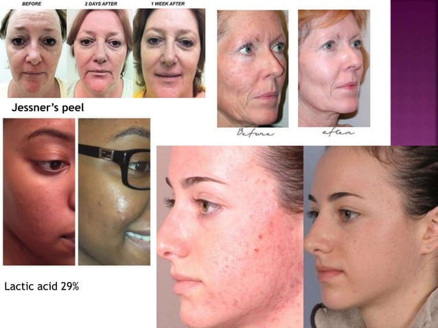 LACTIC ACID PEEL @ CHENNAI PLASTIC SURGERY | PPT
