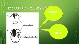 Lacunar syndromes | PPT