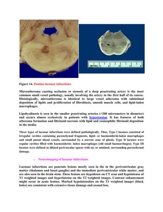 Radiological pathology of microvascular brain disease | PDF