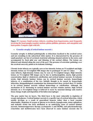 Radiological pathology of microvascular brain disease | PDF