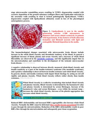 Radiological pathology of microvascular brain disease | PDF
