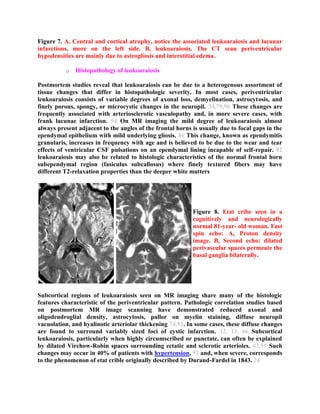 Radiological pathology of microvascular brain disease | PDF
