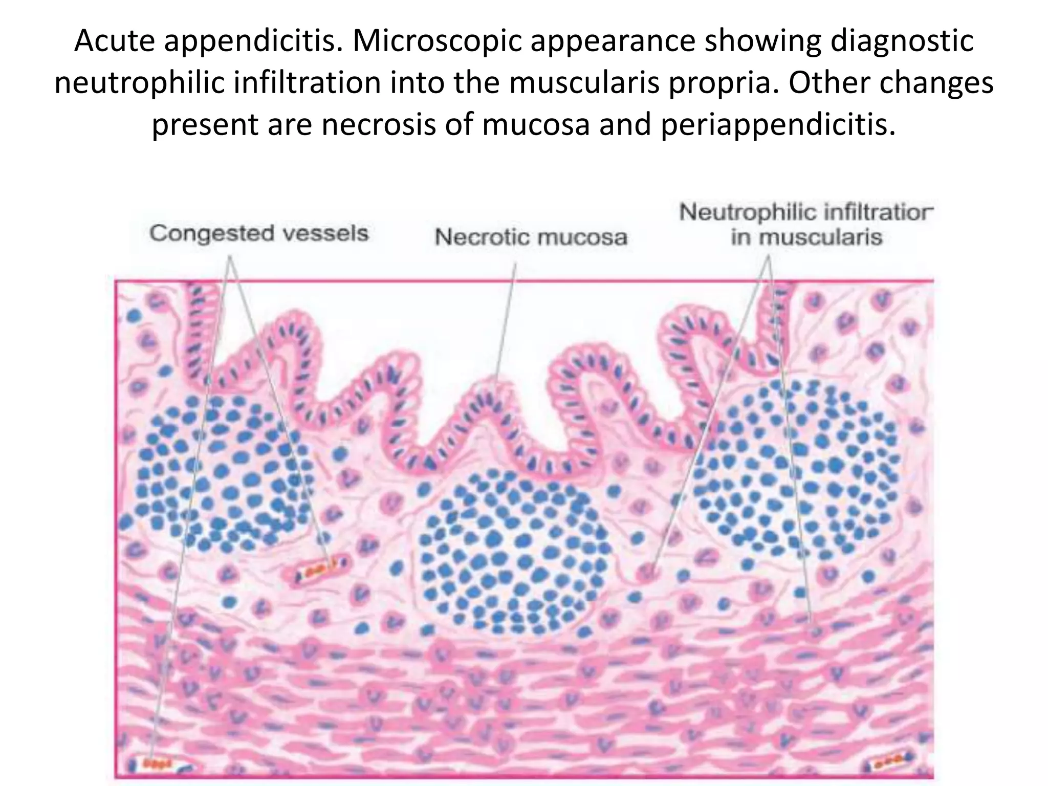L acute appendicitis | PPTX