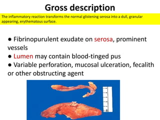 L acute appendicitis | PPTX