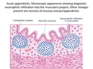 L acute appendicitis | PPTX