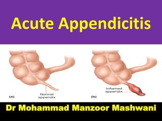 Infected Appendix Vs Normal Appendix