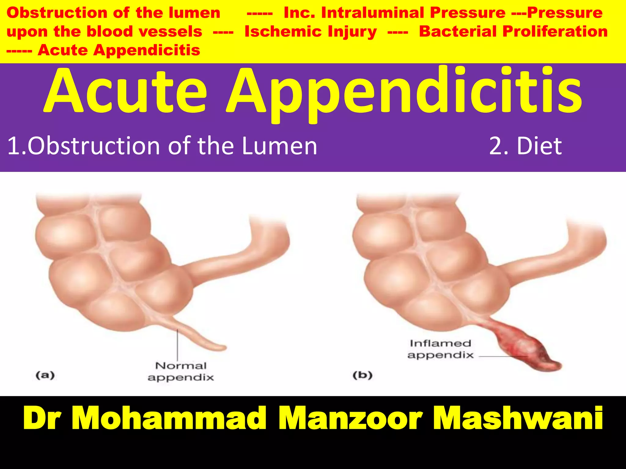 L acute appendicitis | PPT