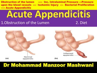 L acute appendicitis | PPT