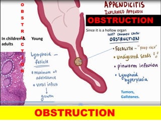 L acute appendicitis | PPT