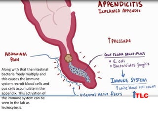 L acute appendicitis | PPTX