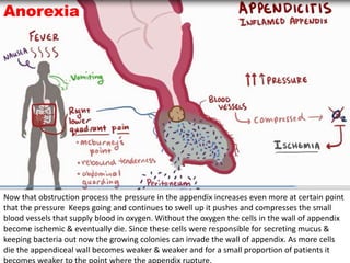 L acute appendicitis | PPTX