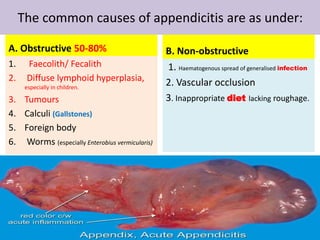 L acute appendicitis | PPT
