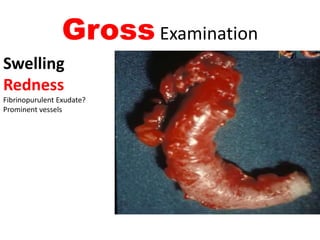 L acute appendicitis | PPT