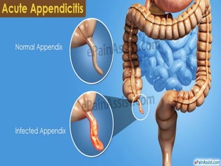 L acute appendicitis | PPTX
