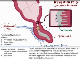 L acute appendicitis | PPT