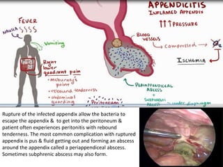 L acute appendicitis | PPT