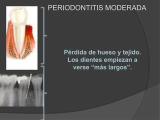 La enfermedad periodontal | PPTX