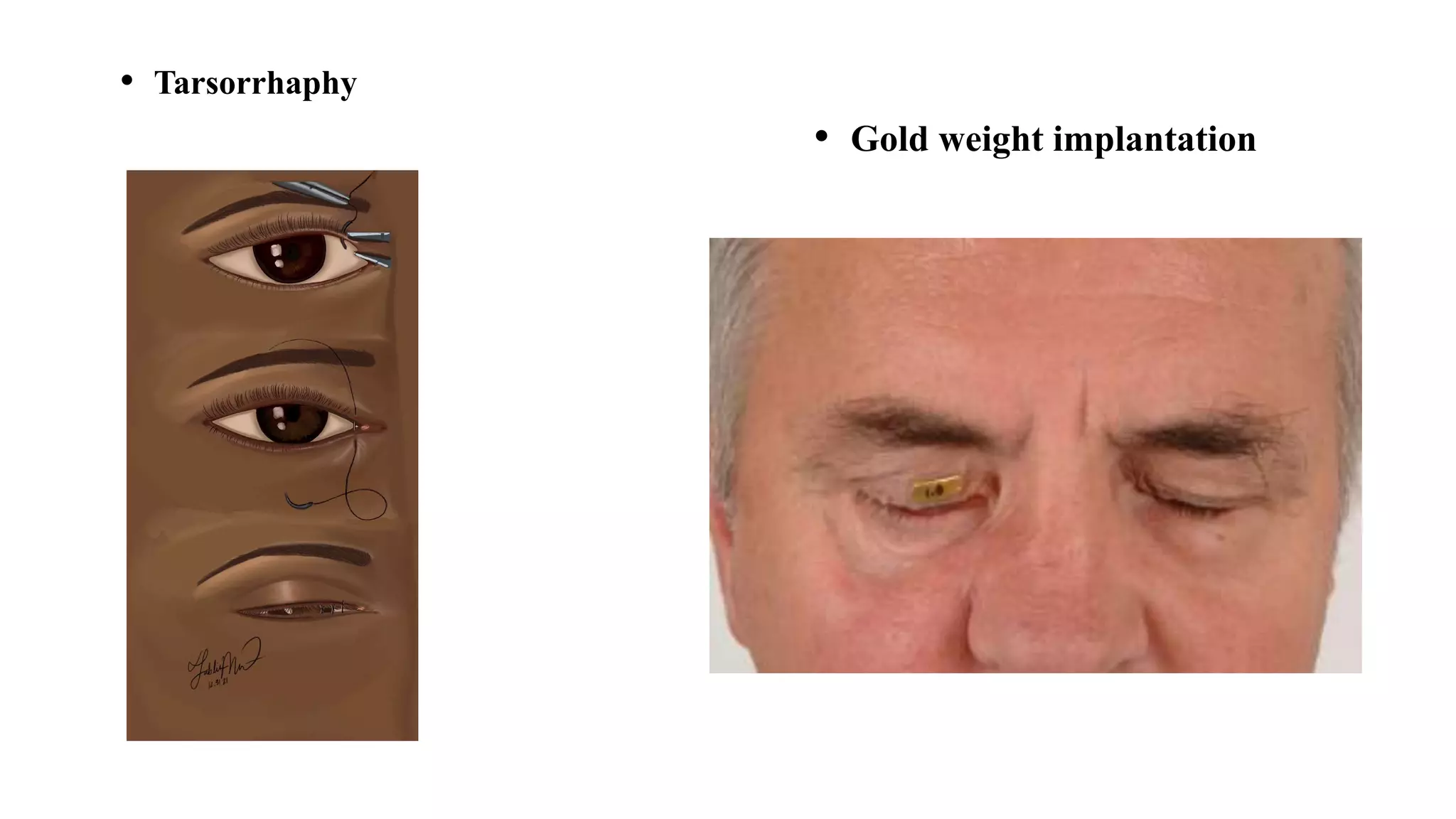 Lagophthalmos.ppt