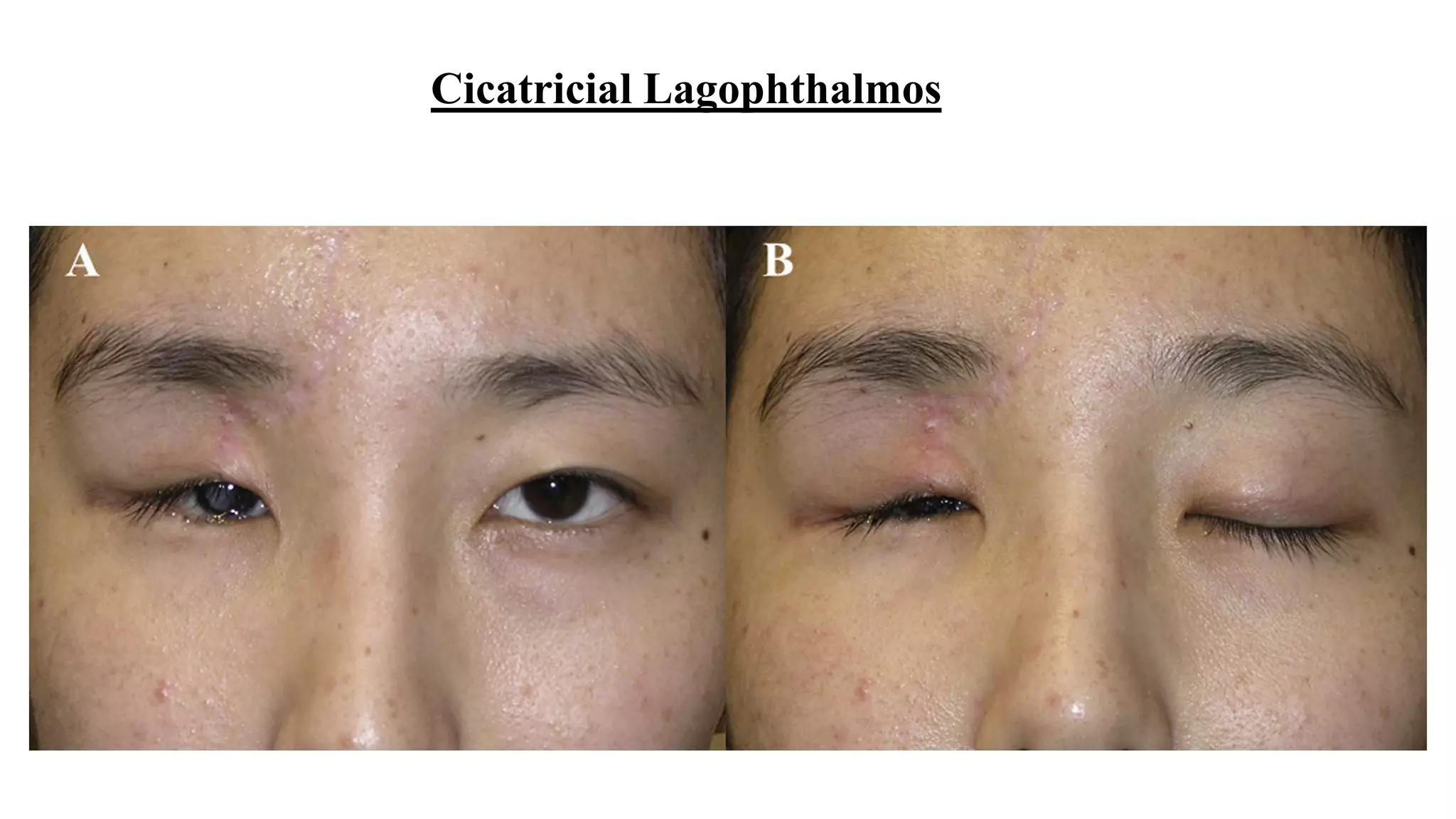 Lagophthalmos.ppt