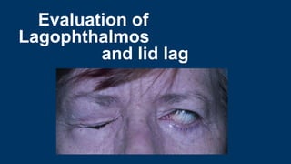 Lagophthalmos.ppt