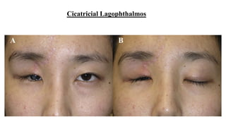 Lagophthalmos.ppt