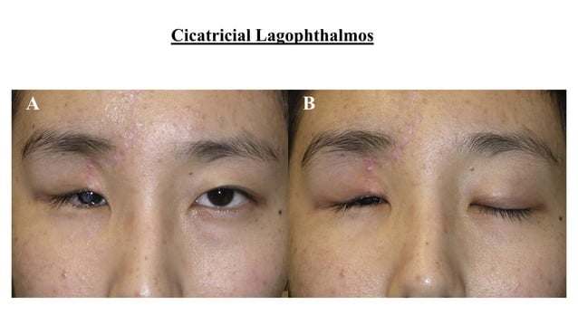 Lagophthalmos.ppt | Ear, Nose and Throat Conditions | Diseases and ...