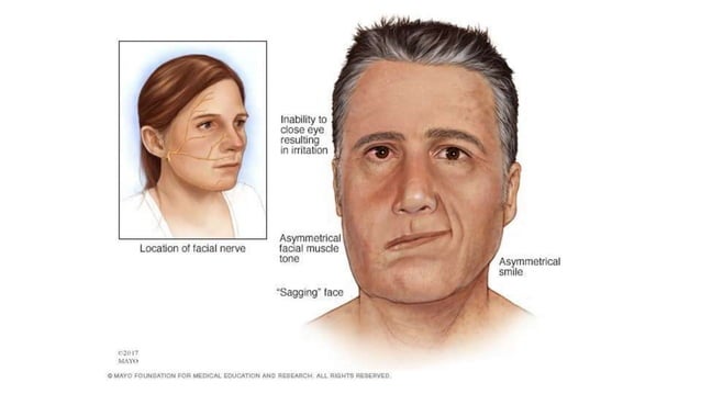 Lagophthalmos.ppt | Ear, Nose and Throat Conditions | Diseases and ...