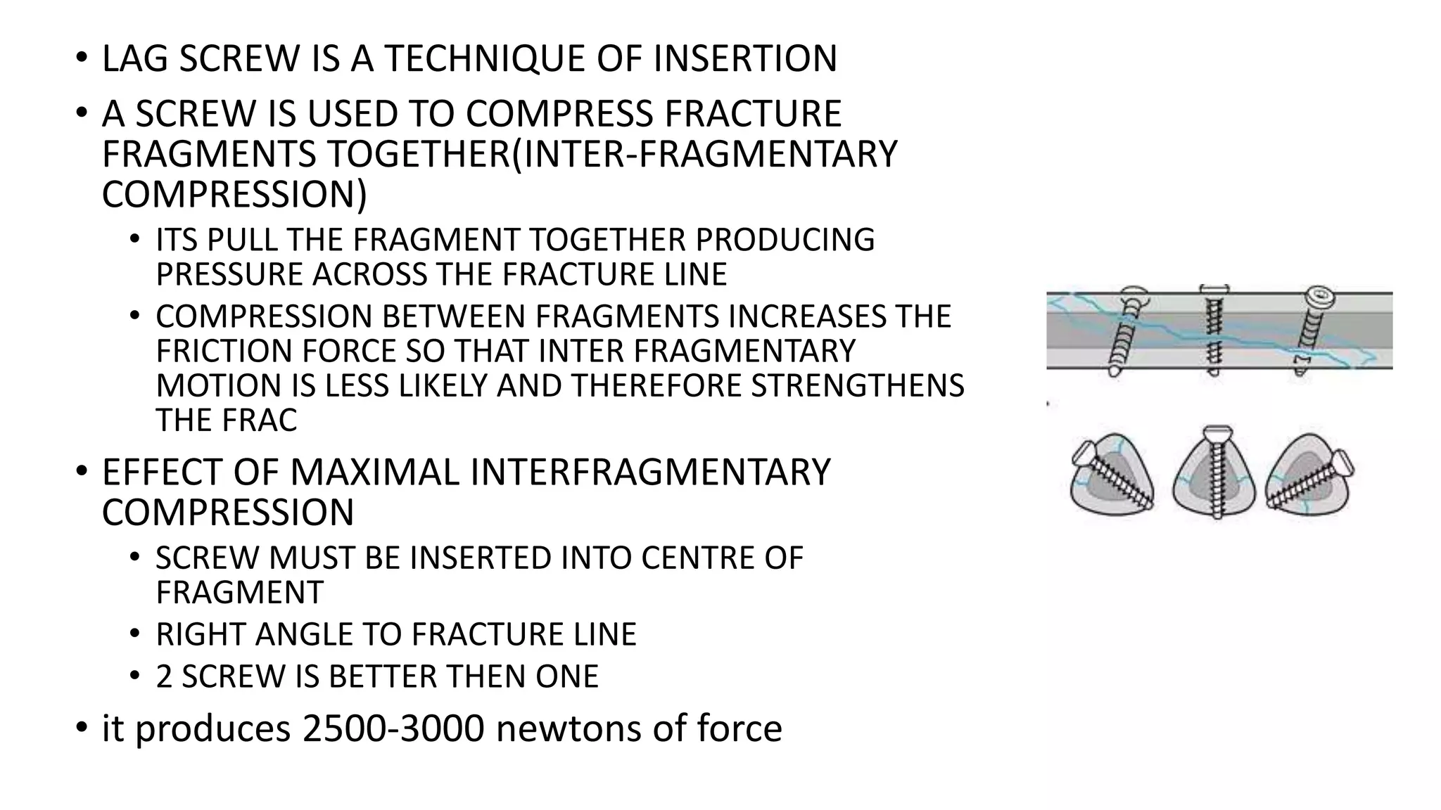 LAG SCREW PRINCIPLES.ppt