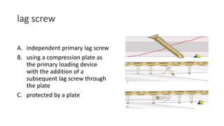 LAG SCREW PRINCIPLES.ppt