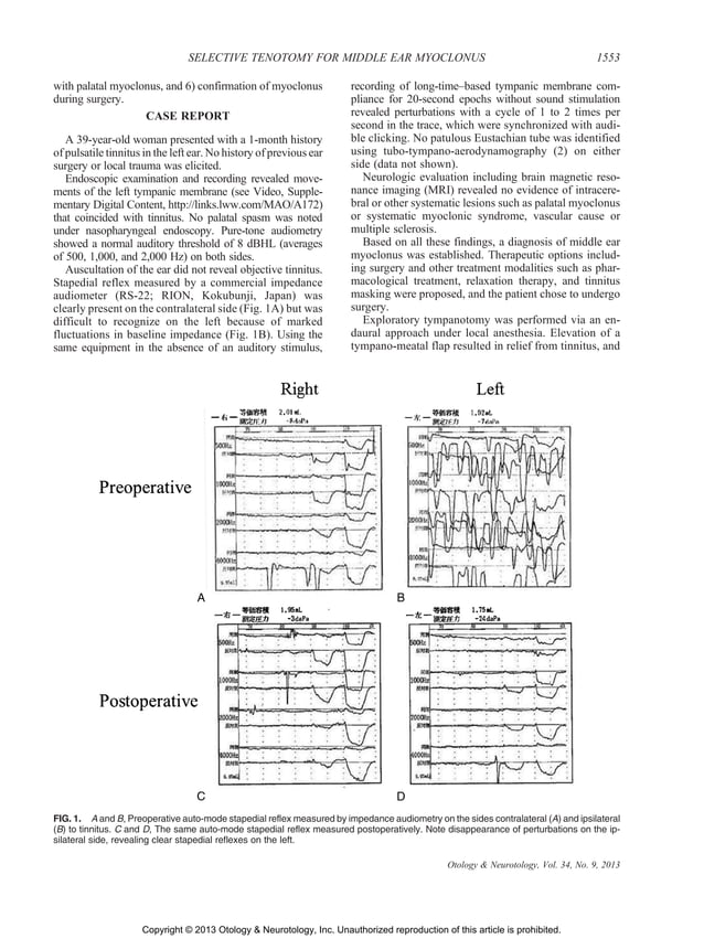 Middle ear myoclonus | PDF