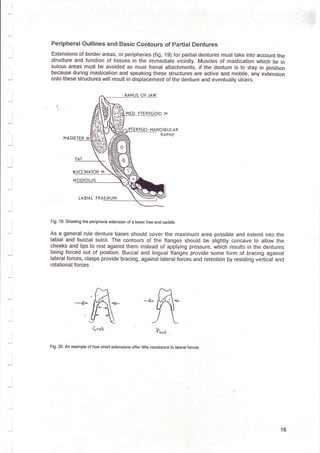 Lambeth college removable partial dentures | PDF