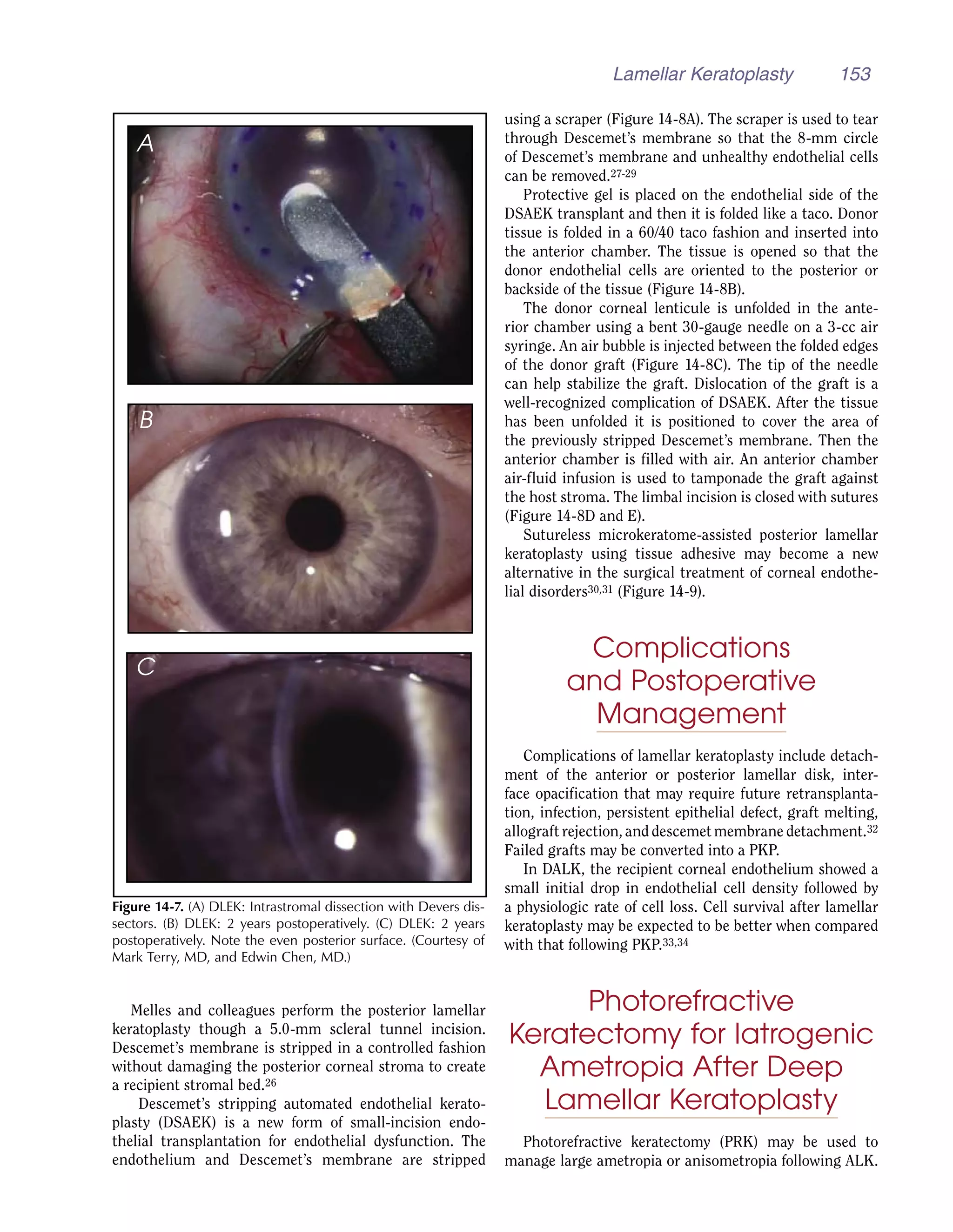 Lamellar Keratoplasty by Michael Duplessie | PDF