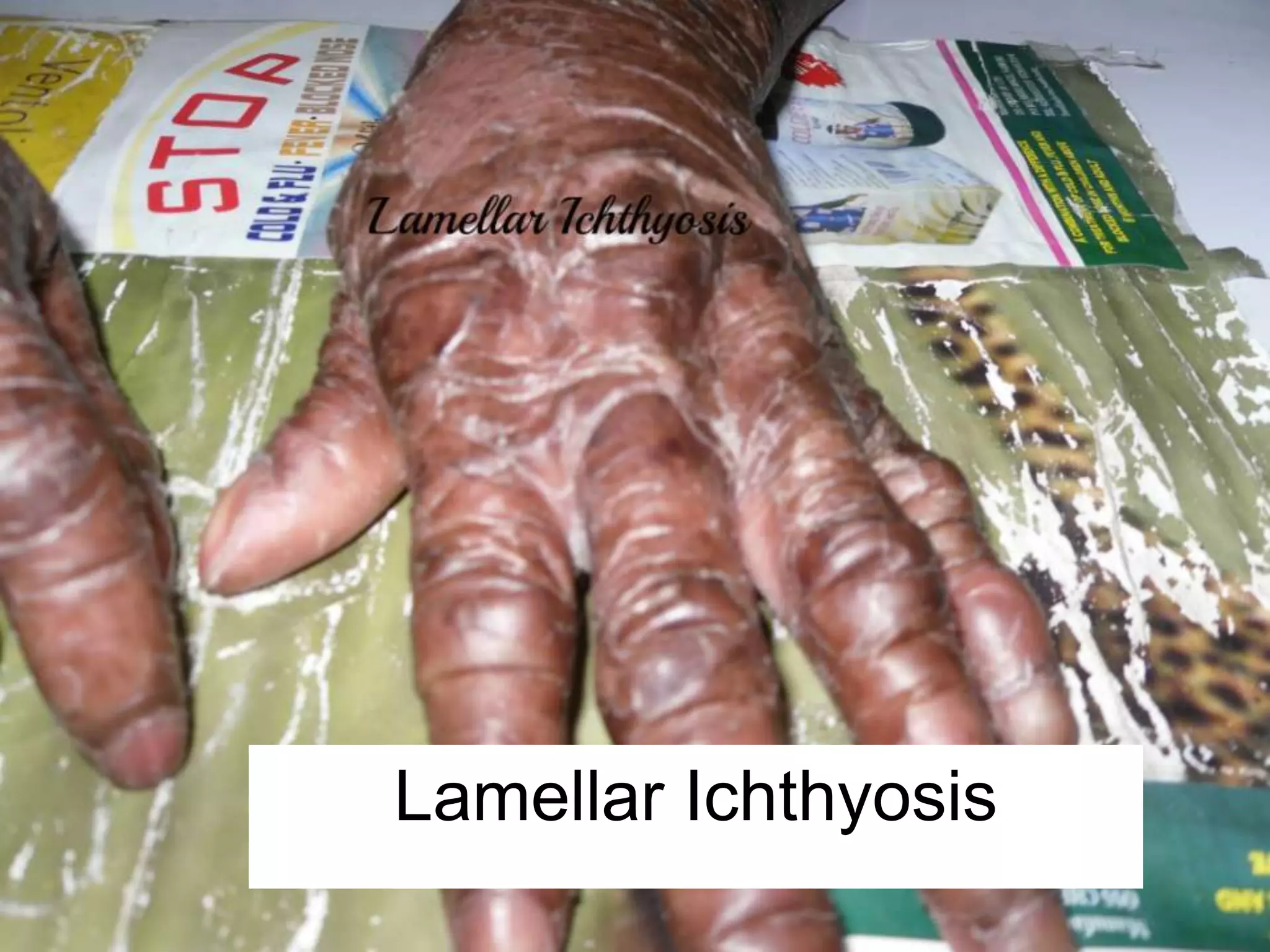 Lamellar Ichthyosis Ppt