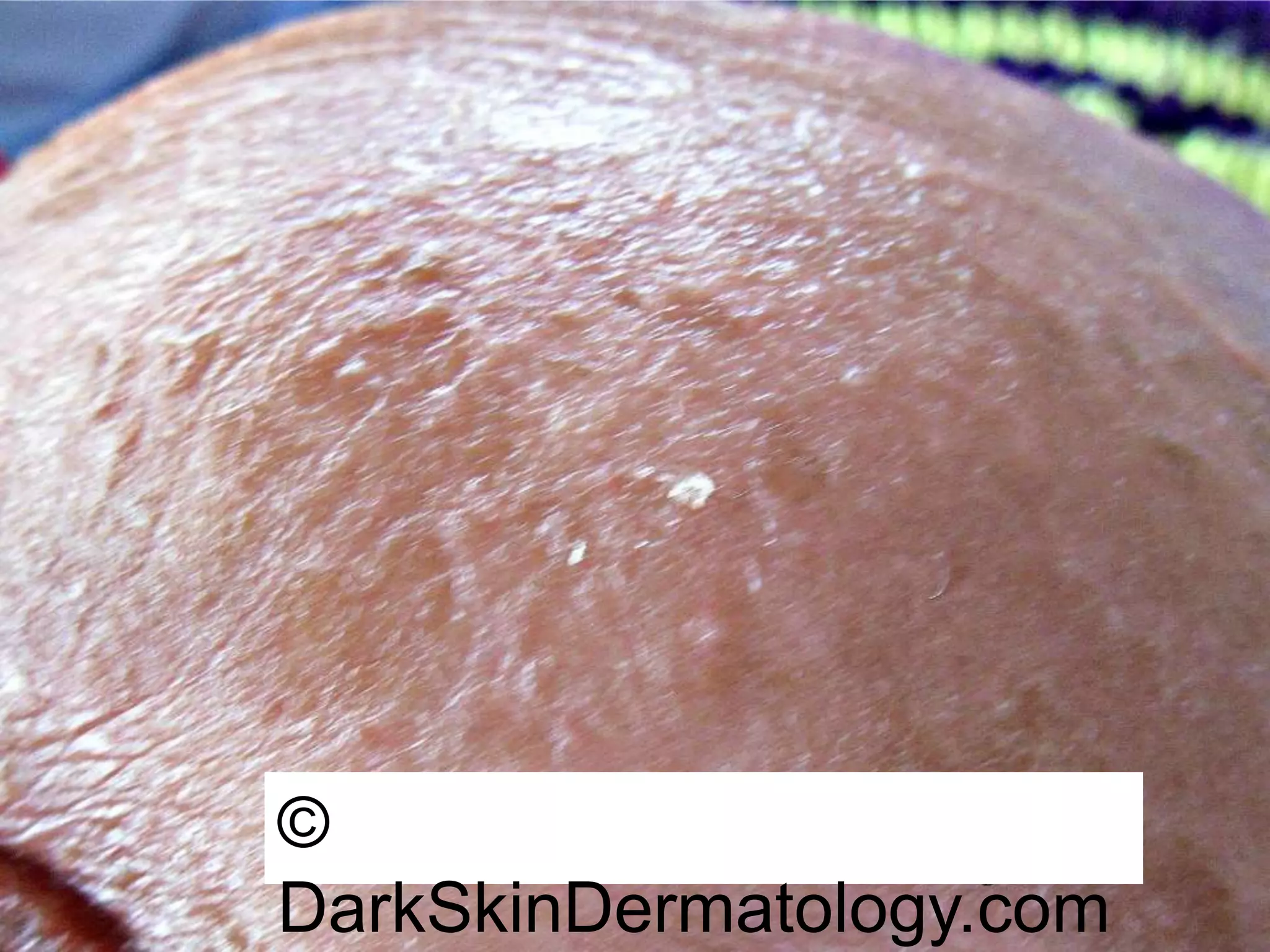 Lamellar ichthyosis | PPTX