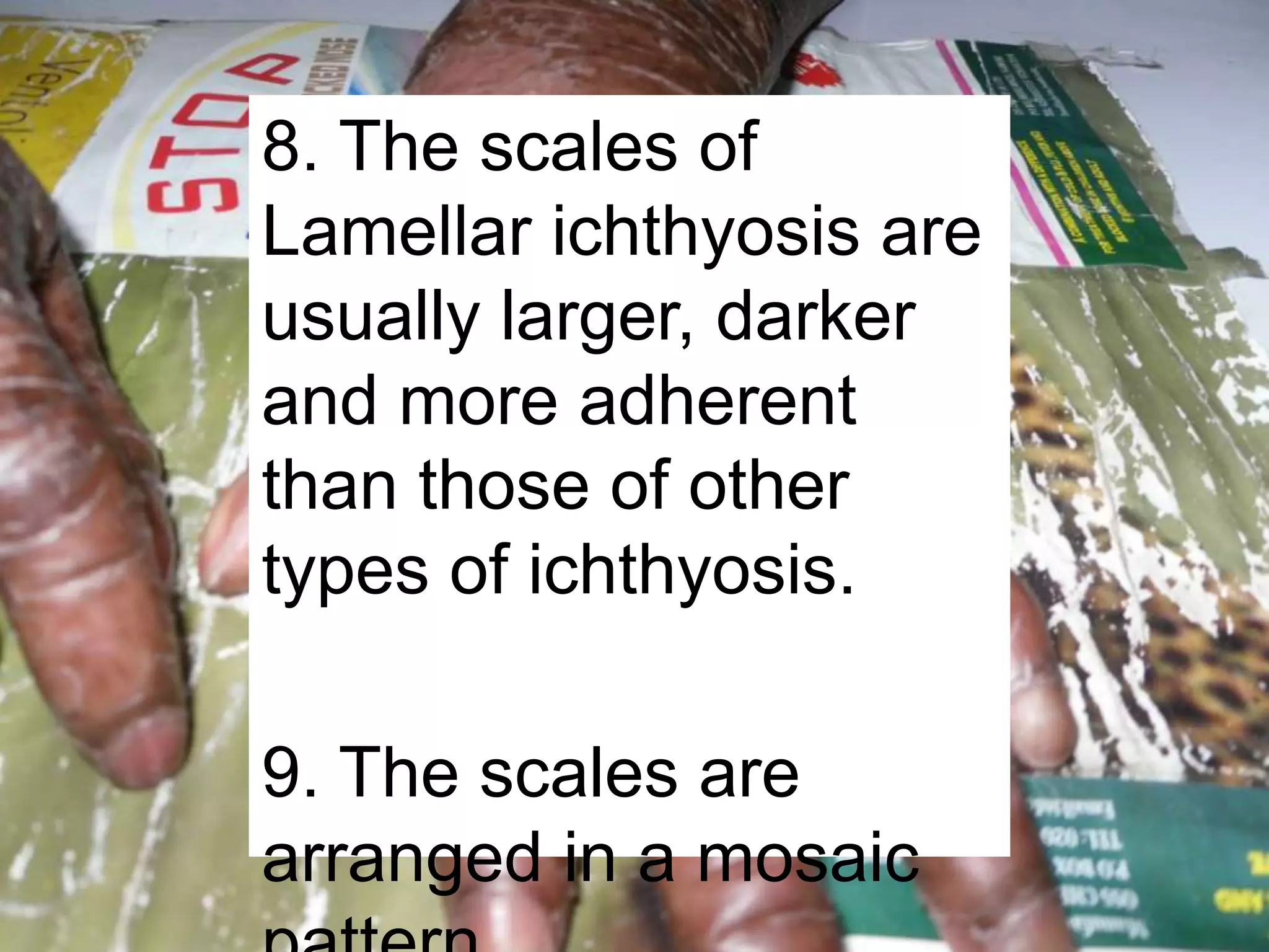 Lamellar ichthyosis | PPTX