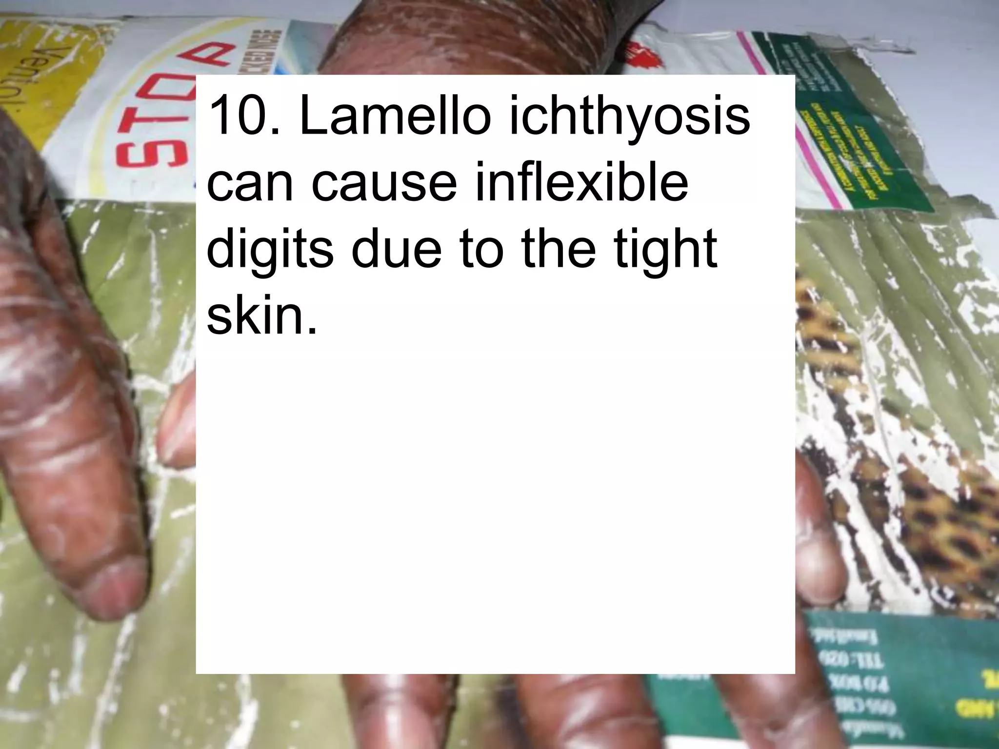 Lamellar ichthyosis | PPTX