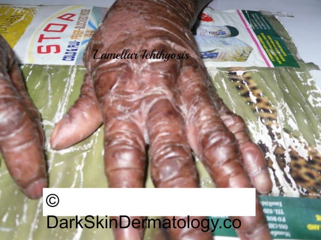 Lamellar ichthyosis | PPTX
