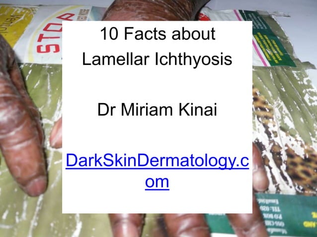 Lamellar ichthyosis | PPTX