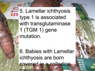 Lamellar ichthyosis | PPTX