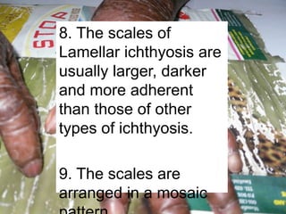 Lamellar ichthyosis | PPTX