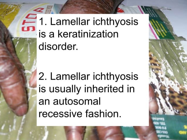 Lamellar Ichthyosis