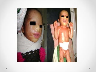Lamellar ichthyosis: Discussion | PPTX