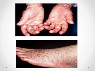 Lamellar ichthyosis: Discussion | PPTX