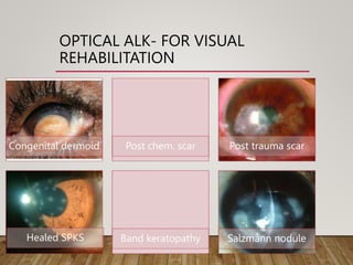 lamellar keratoplasty ophthalmology ophthalmology | PPTX